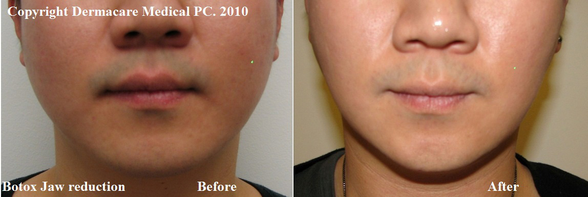NEW YORK BOTOX JAW REDUCTION