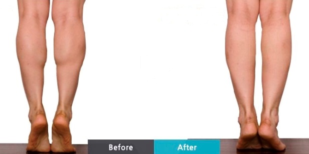 New York botox calf reductione